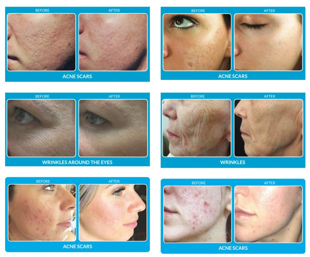 ProCell Micro-channeling Treatment (Single Treatment) – Face Food ...